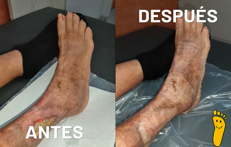 Úlceras – Centro Médico del Pie Diabético
